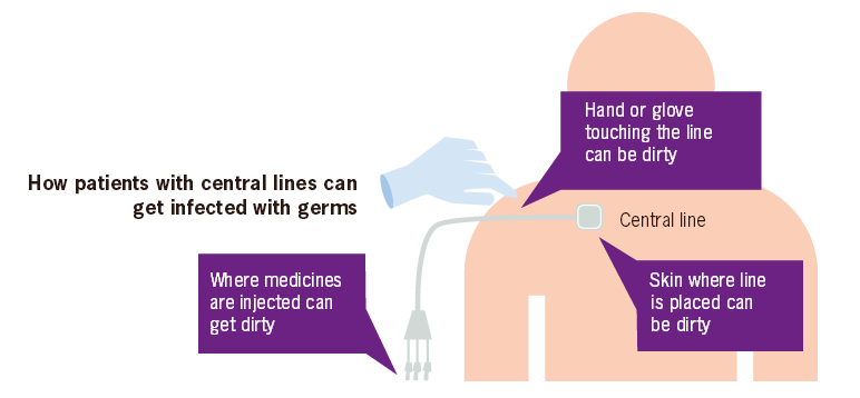 Preventing Central Line Infections