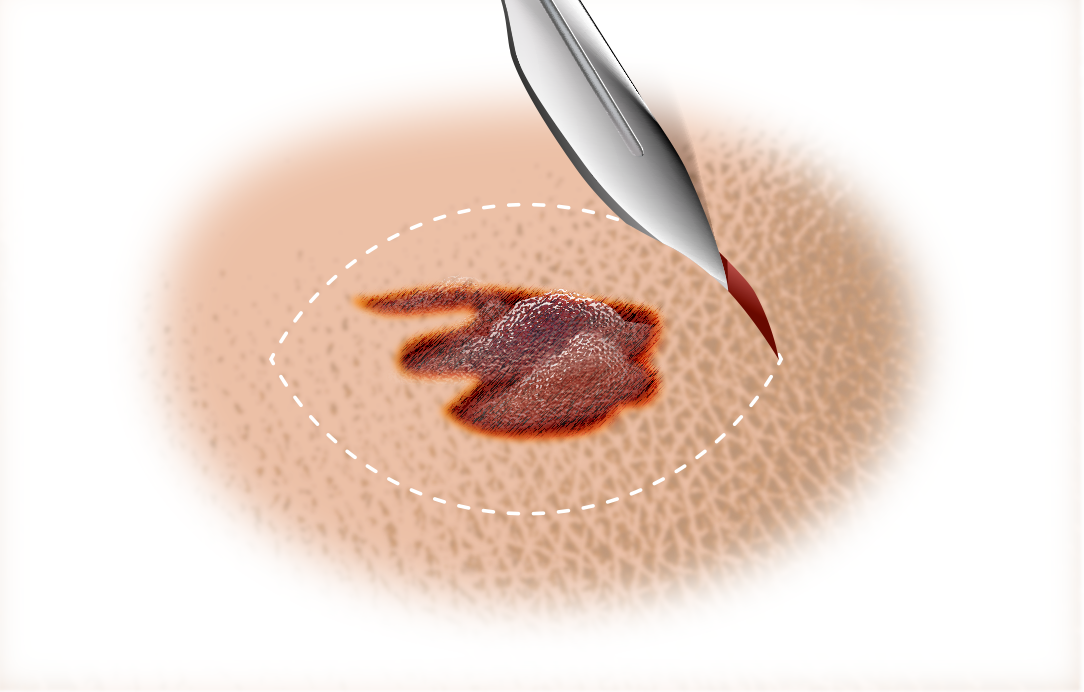 Escisión general para el cáncer de piel no melanoma