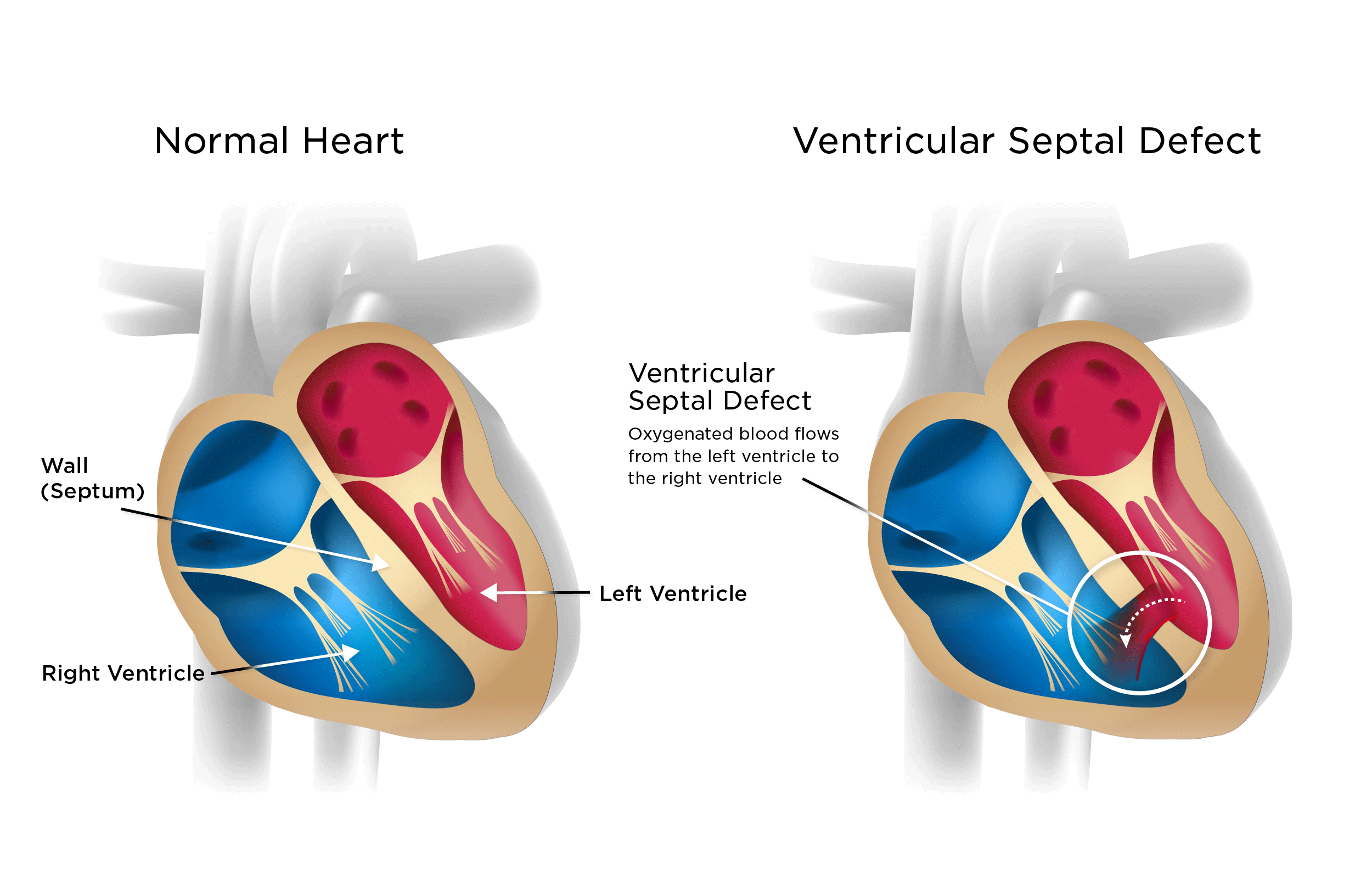 Ventricular Septal Defect