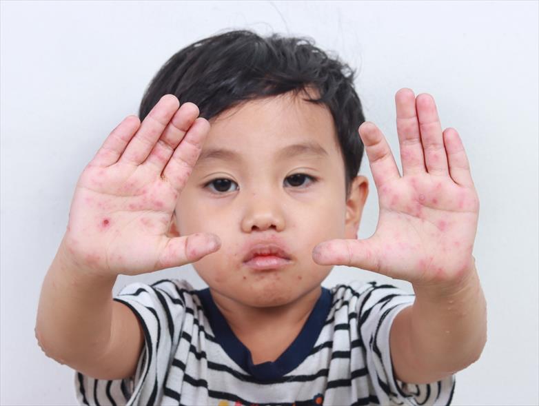 Hand, Foot and Mouth: What Parents Need to Know