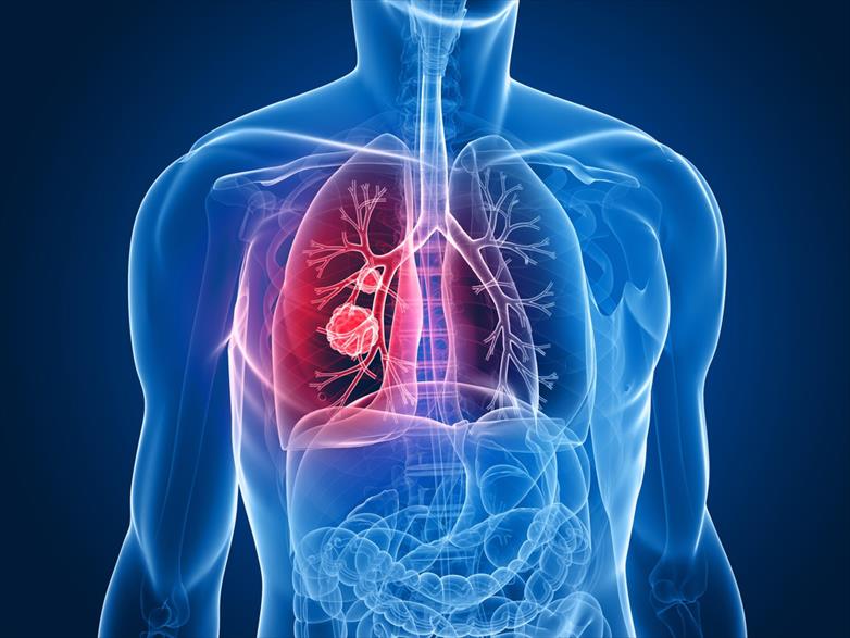 Lung Cancer: Are You at Risk?