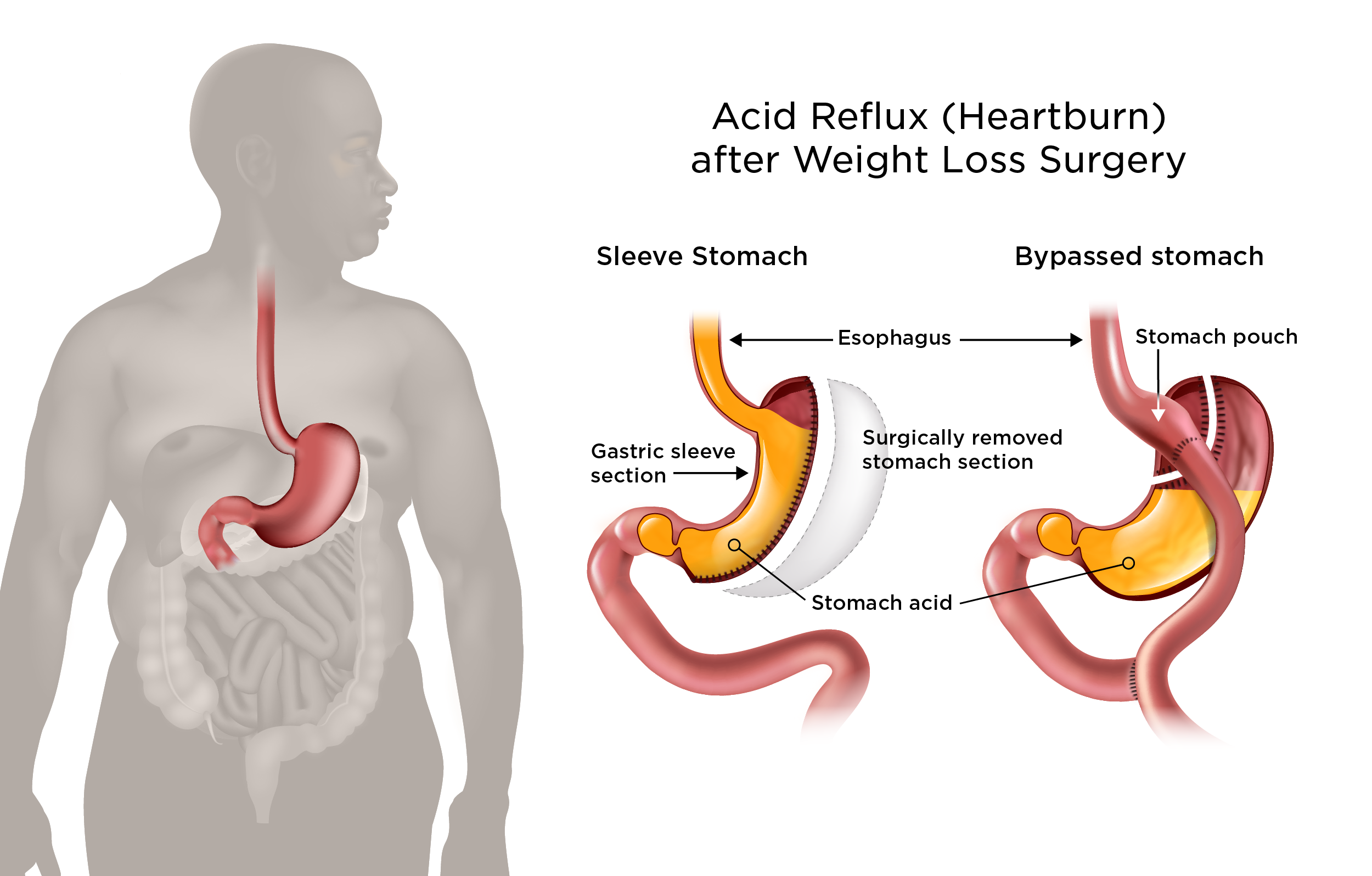Weight Loss Surgery Procedures: Gastric Sleeve and Gastric Bypass | My Doctor Online