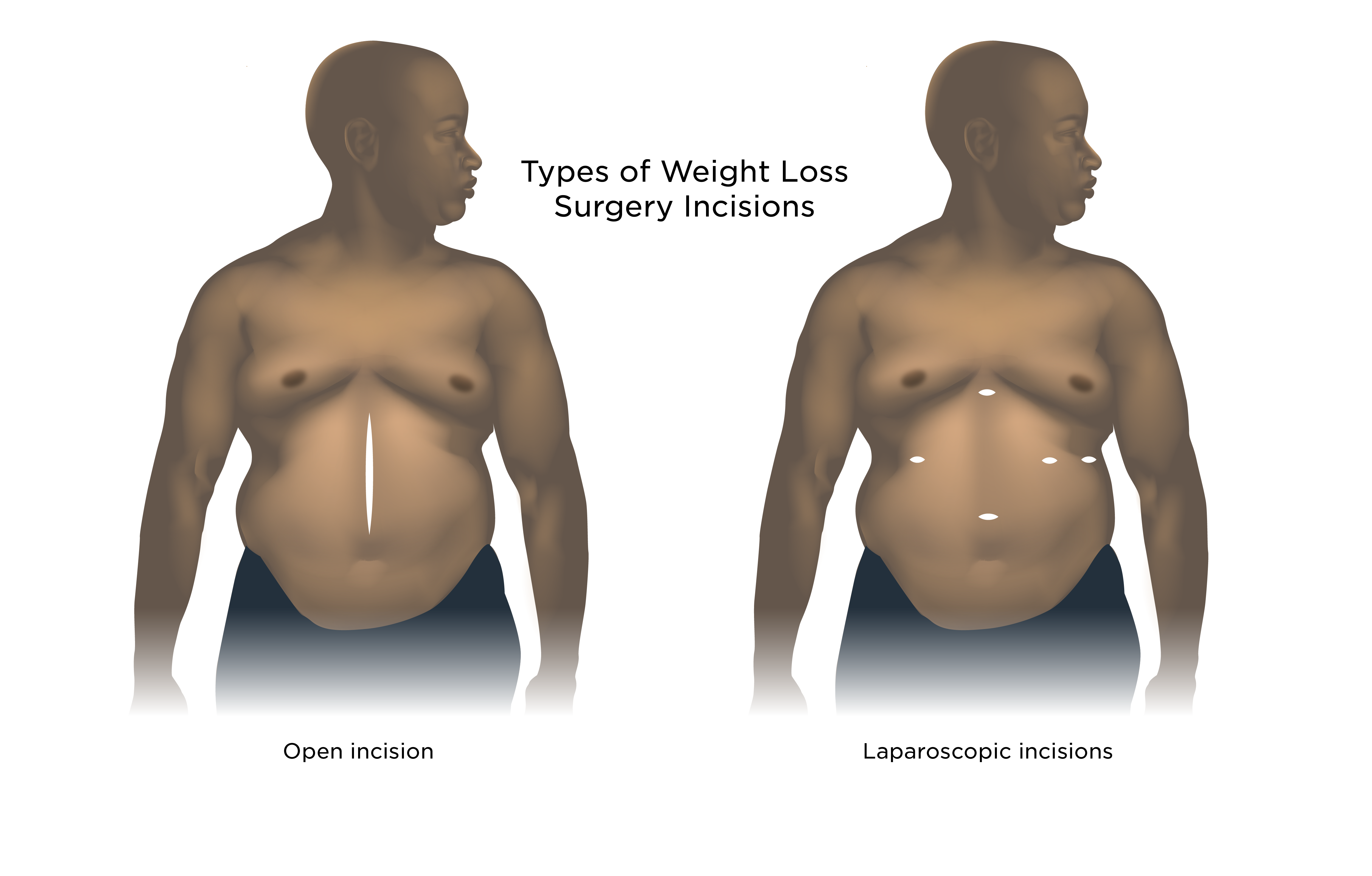 Weight Loss Surgery Procedures: Gastric Sleeve and Gastric Bypass | My Doctor Online