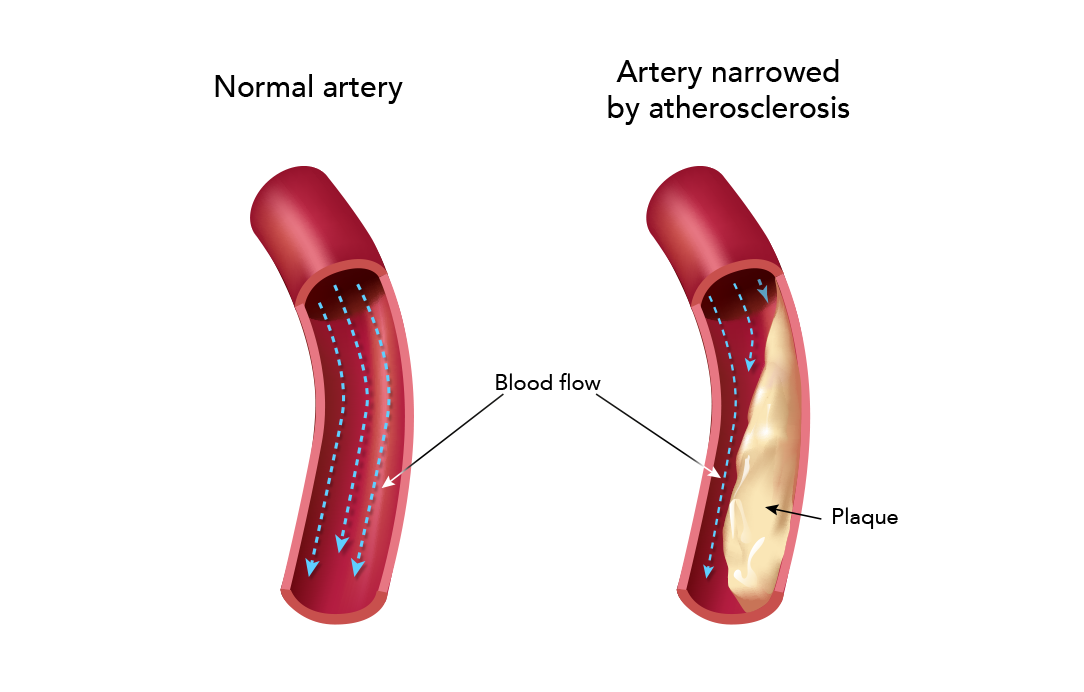 Peripheral Arterial Disease | My Doctor Online