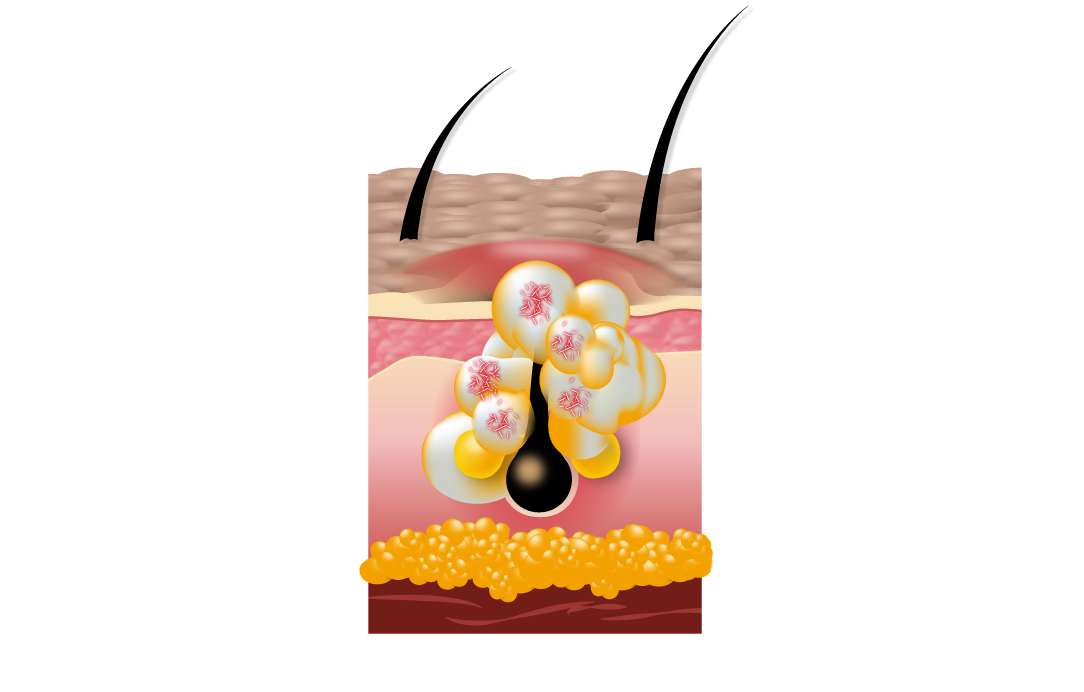 Acne Treatment | My Doctor Online