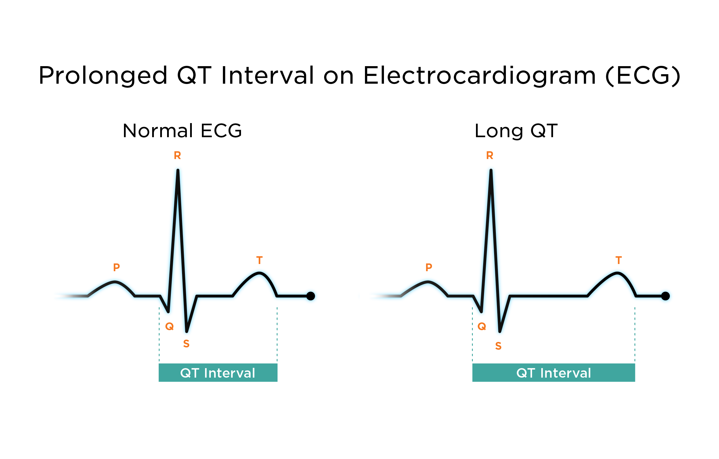 Long QT Syndrome | My Doctor Online