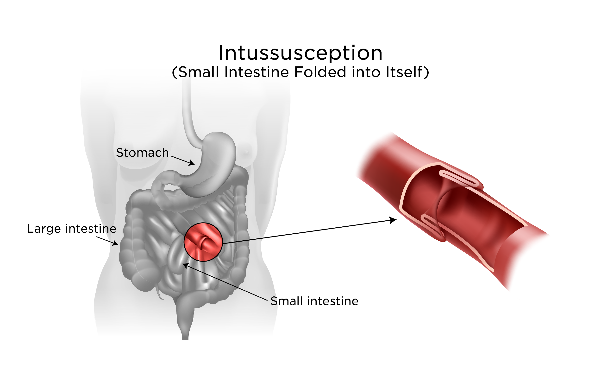 Possible Complications and Side Effects of Weight Loss Surgery | My ...