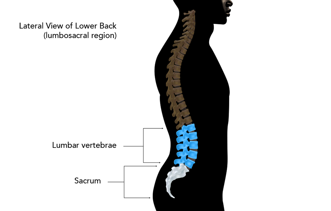 Lumbosacral Radiculopathy (Sciatica) | My Doctor Online