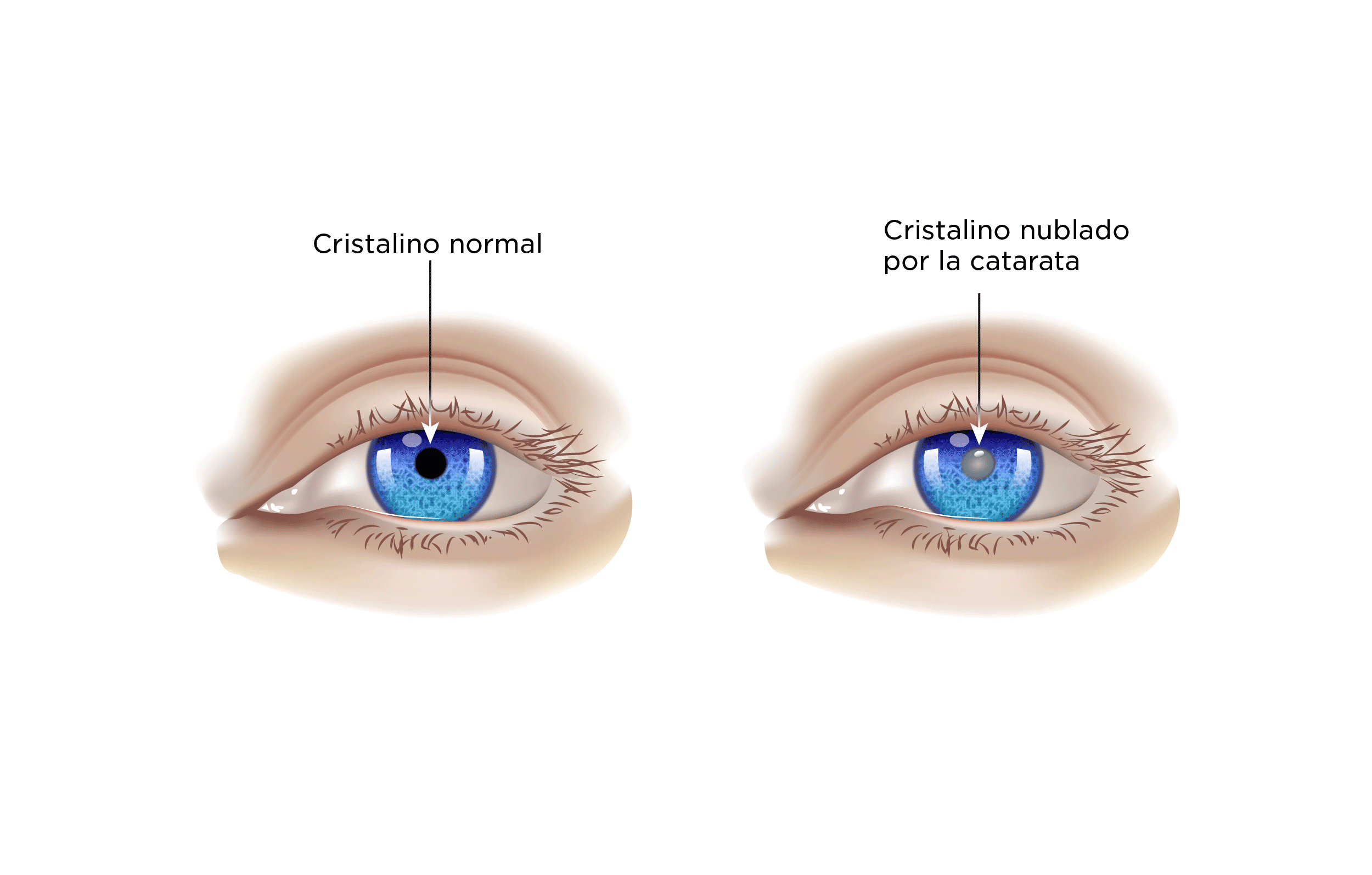 Las cataratas y la cirugía de cataratas | My Doctor Online