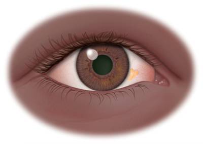 Pinguecula and Pterygium | My Doctor Online