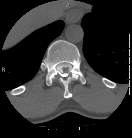 Myelography | My Doctor Online