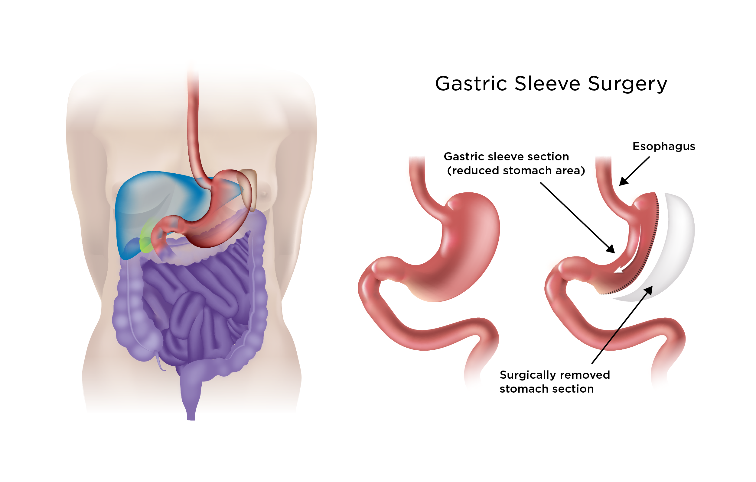 Weight Loss Surgery Procedures: Gastric Sleeve and Gastric Bypass | My Doctor Online