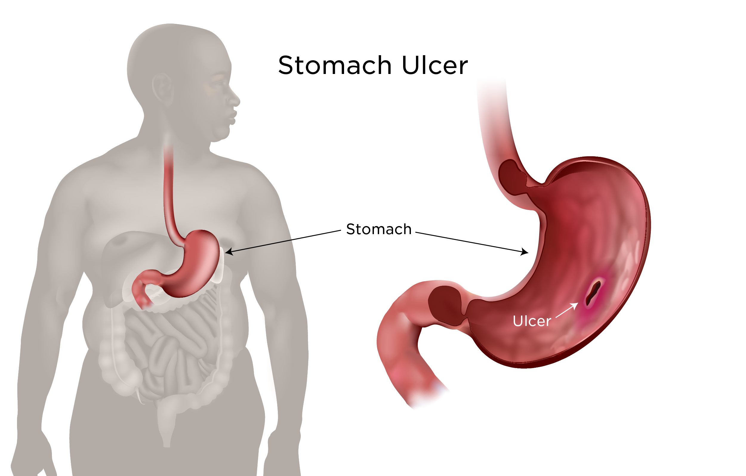 Possible Complications and Side Effects of Weight Loss Surgery | My ...