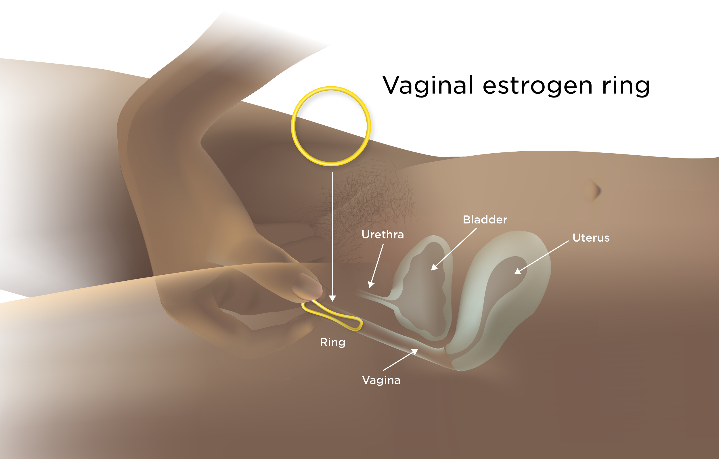 Vaginal Estrogen Treatment for GSM Symptoms | My Doctor Online