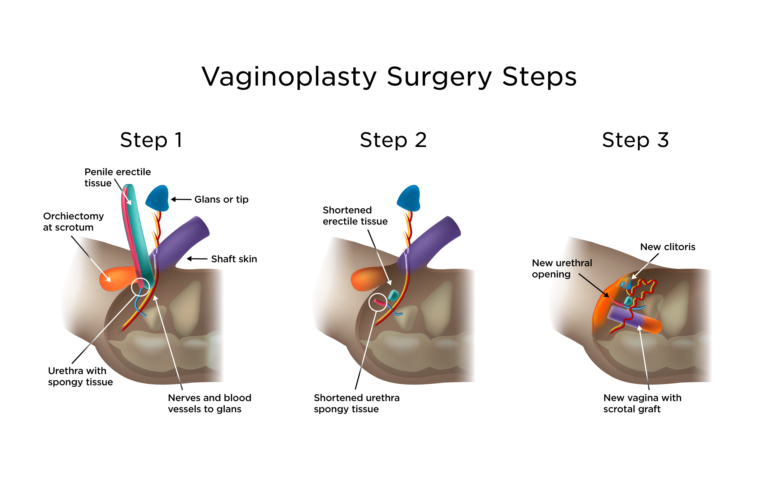Vaginoplasty and Other Gender-Affirming Genital Surgical Options | My Doctor Online