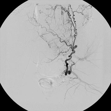 Uterine Fibroid Embolization | My Doctor Online