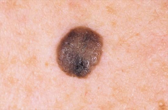 Skin Lumps, Bumps, and Growths | My Doctor Online