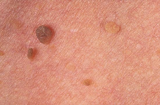 Skin Lumps, Bumps, and Growths | My Doctor Online