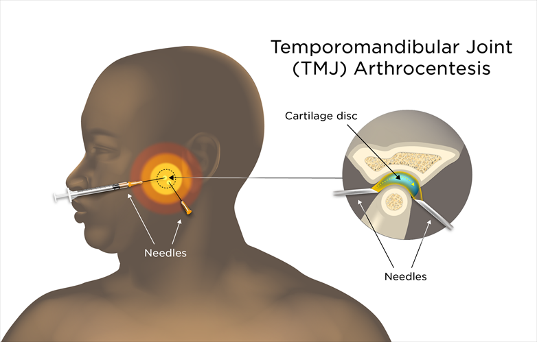 Temporomandibular Joint Disorder Arthrocentesis (Joint Washout) | My ...