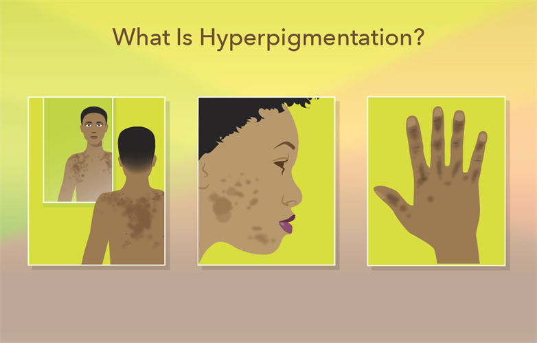 What You Should Know about Hyperpigmentation | My Doctor Online